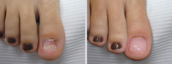 KeryFlex Nail Restoration in Houston - DeNiel Foot & Ankle Center