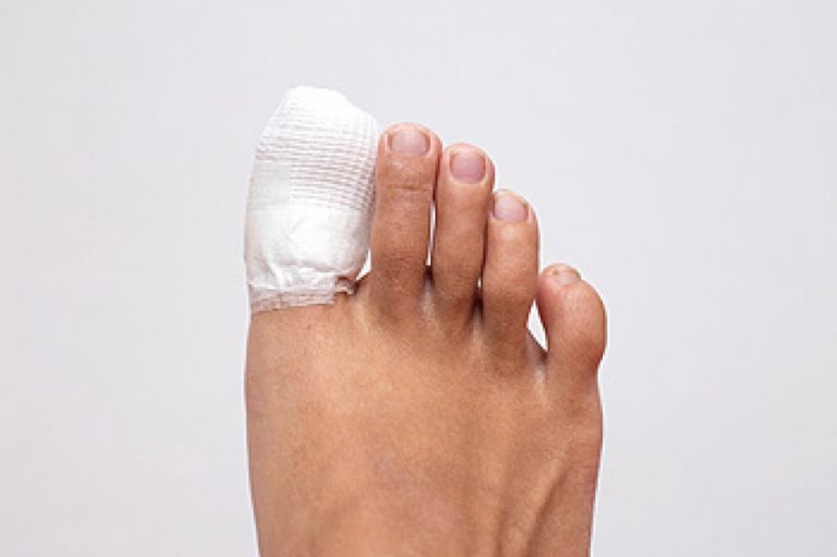 Is it Possible to Have a Sprained Toe?