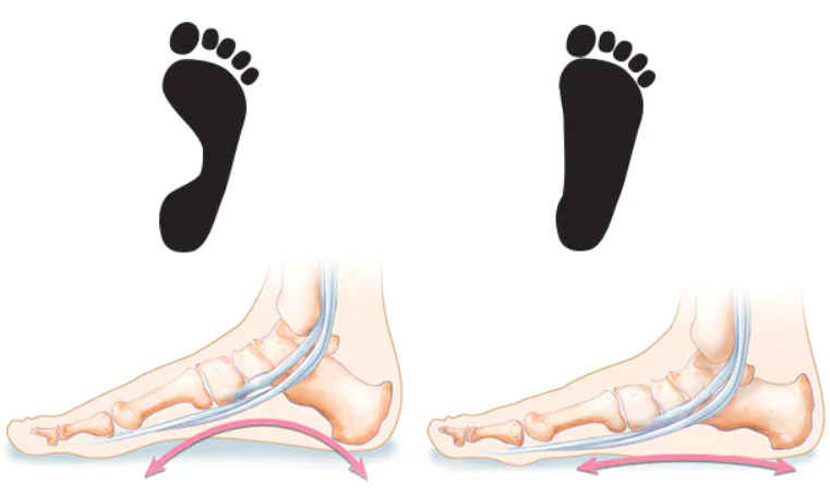 What Are the Different Types of Flat Feet?