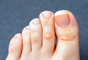 Does a Corn Grow from a Seed? | DeNiel Foot and Ankle Center