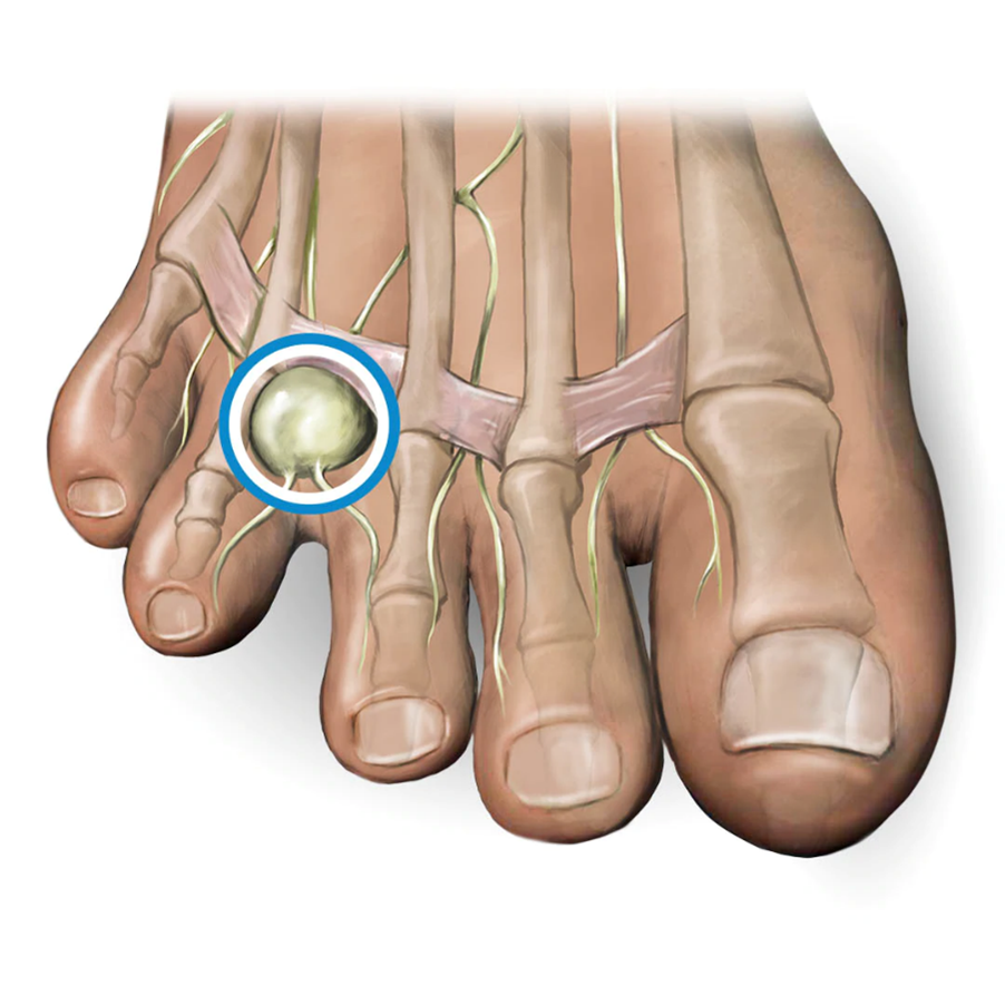 Are Neuromas Recurrent After Surgery?