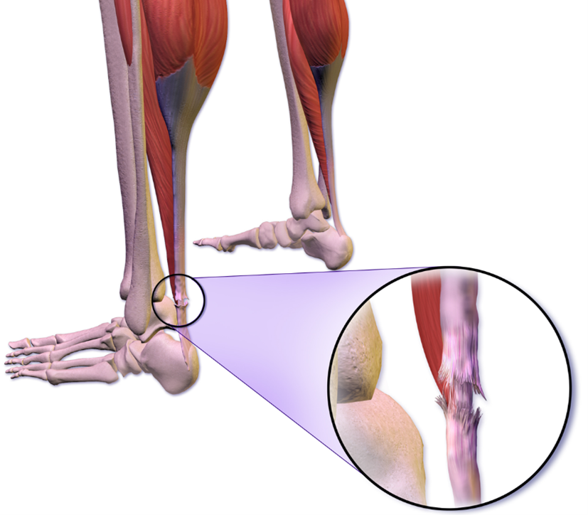How can I tell if my Achilles Tendon is Ruptured?