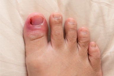 Let's See How Well You Know About Ingrown Toenails