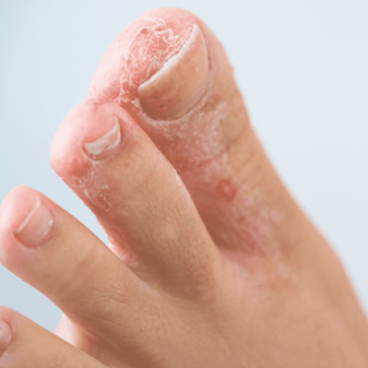 Athlete's Foot Won't Go Away: Causes, Symptoms, and Treatments