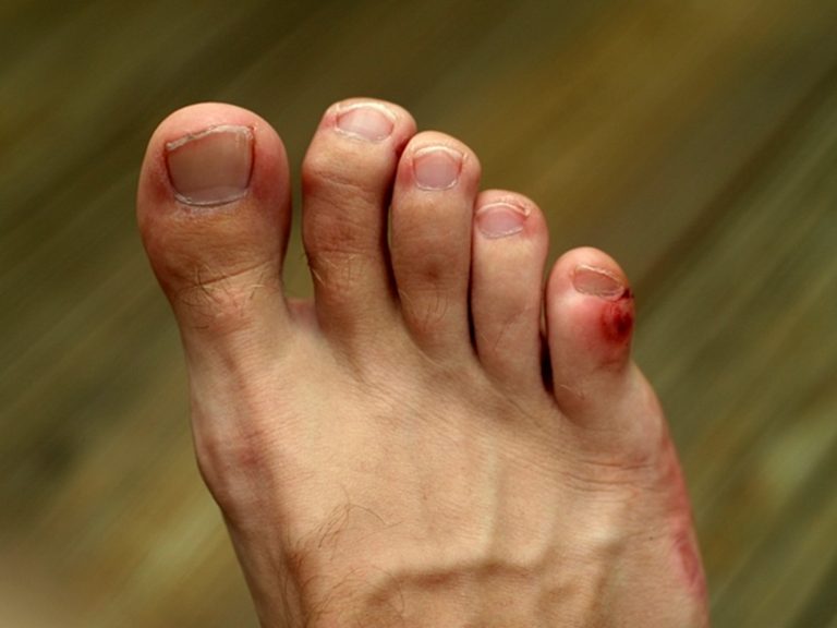 How to Treat a Stubbed Toe?