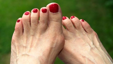5 Genetic Foot Problems You Can Beat