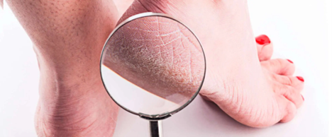 Managing Dry Feet: A Podiatrist's Perspective