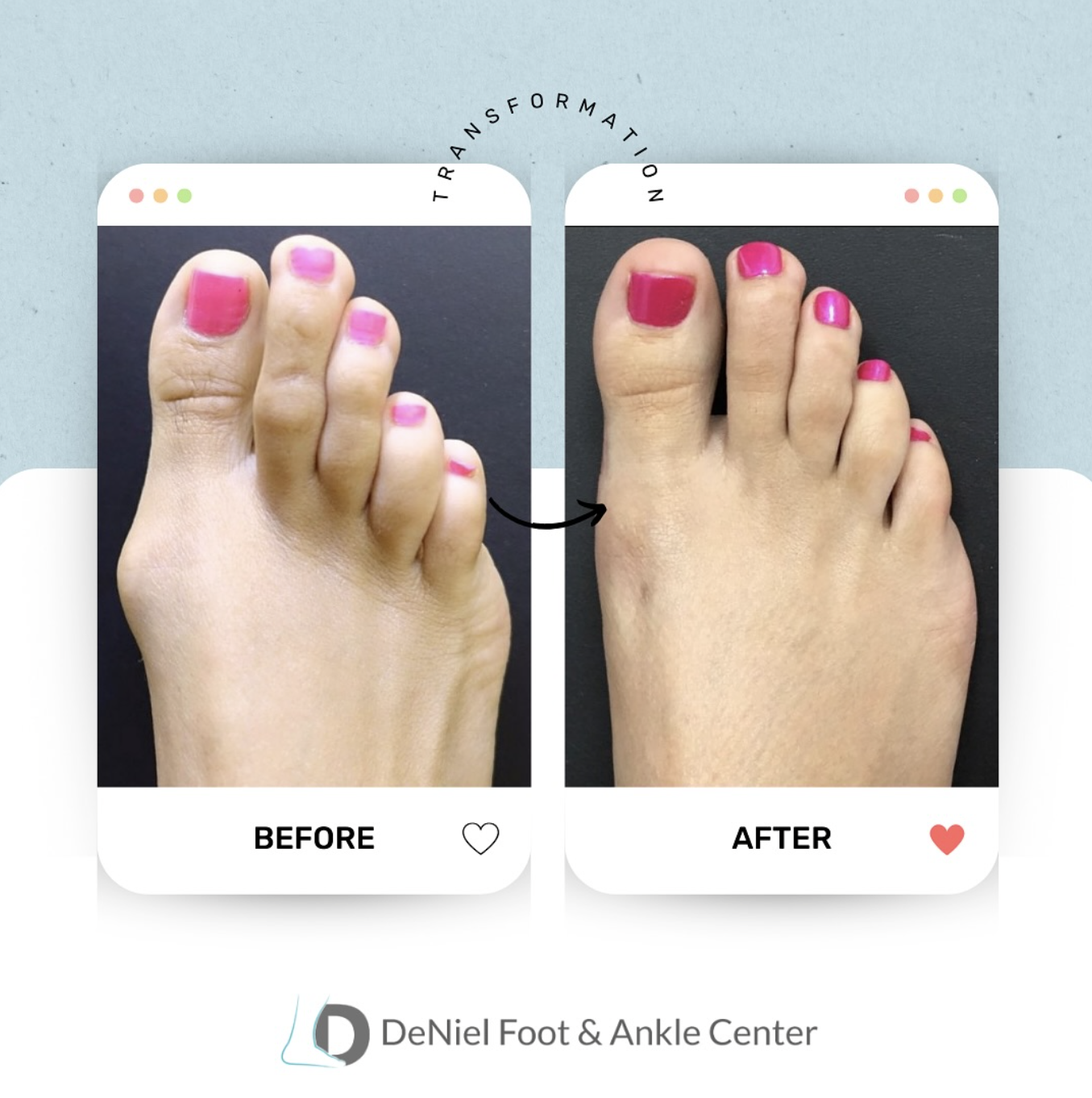 A Guide to Foot Cosmetic Surgery Preparation