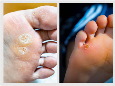 Protecting Feet on the Job: Corns & Calluses