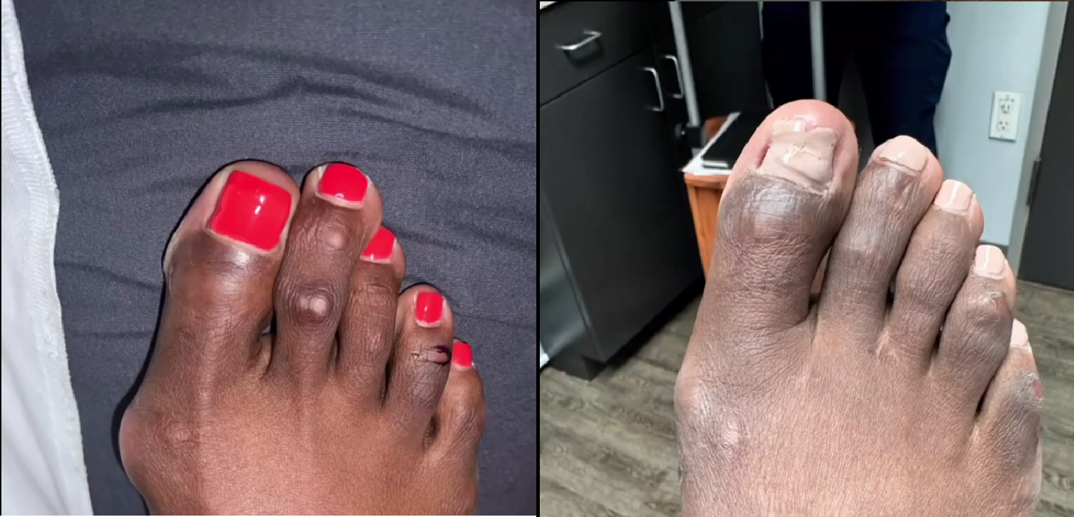 Minimally Invasive Bunion Correction: Peca & Meca