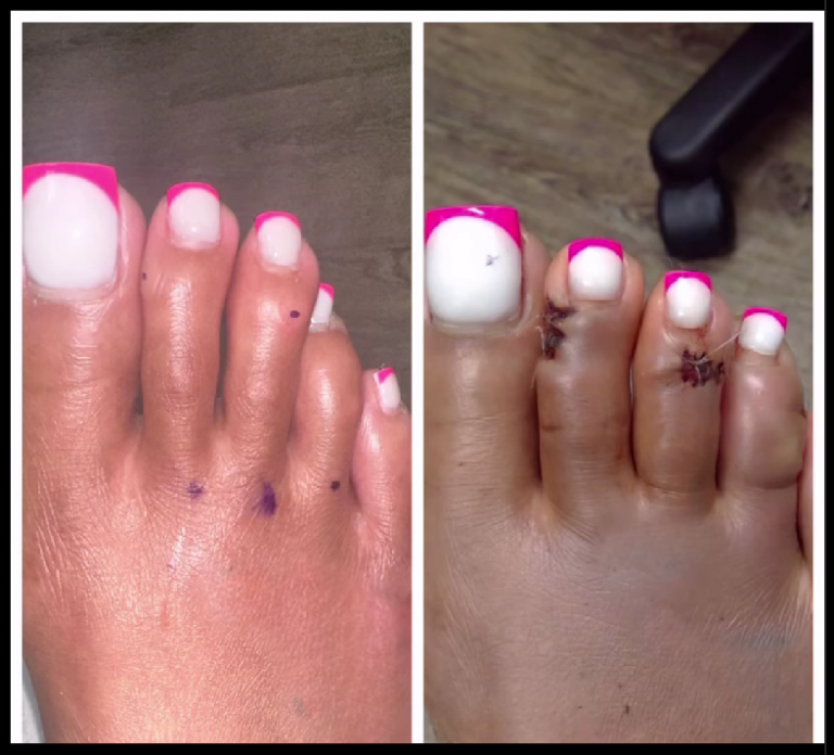 Understanding and Managing Morton's Toe