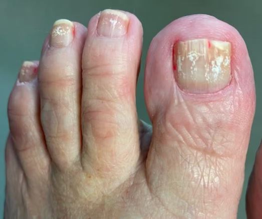 White Lines On Toenails Disorders Of Nails | SpringerLink