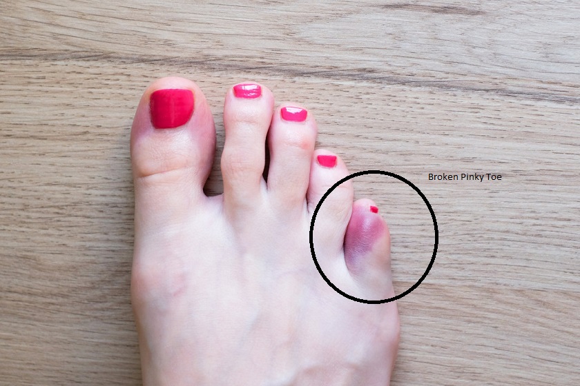 Common Toe Injuries: Broken Pinky Toe, Pinky Toe Fracture, and Big Toe ...