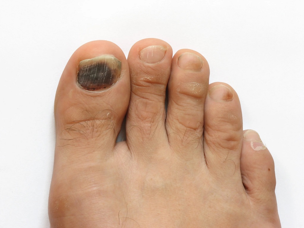 What Do Diabetic Toenails Look Like? Tips to Keep Your Feet Healthy ...