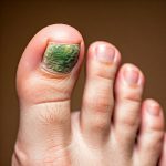 Green Toenail Infection: Causes, Treatment, and Prevention