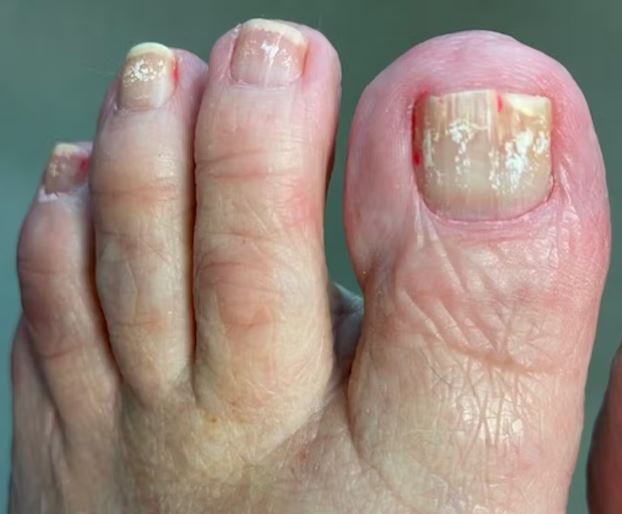 White Toenails? Your Polish Might Be the Culprit!