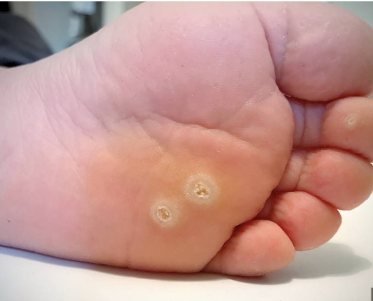 Warts on the Feet: Are They Contagious and What You Should Know