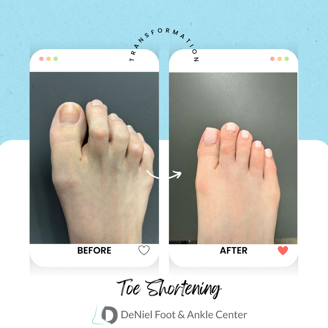 Toe Shortening Surgery Cost in Houston | Expert Insights